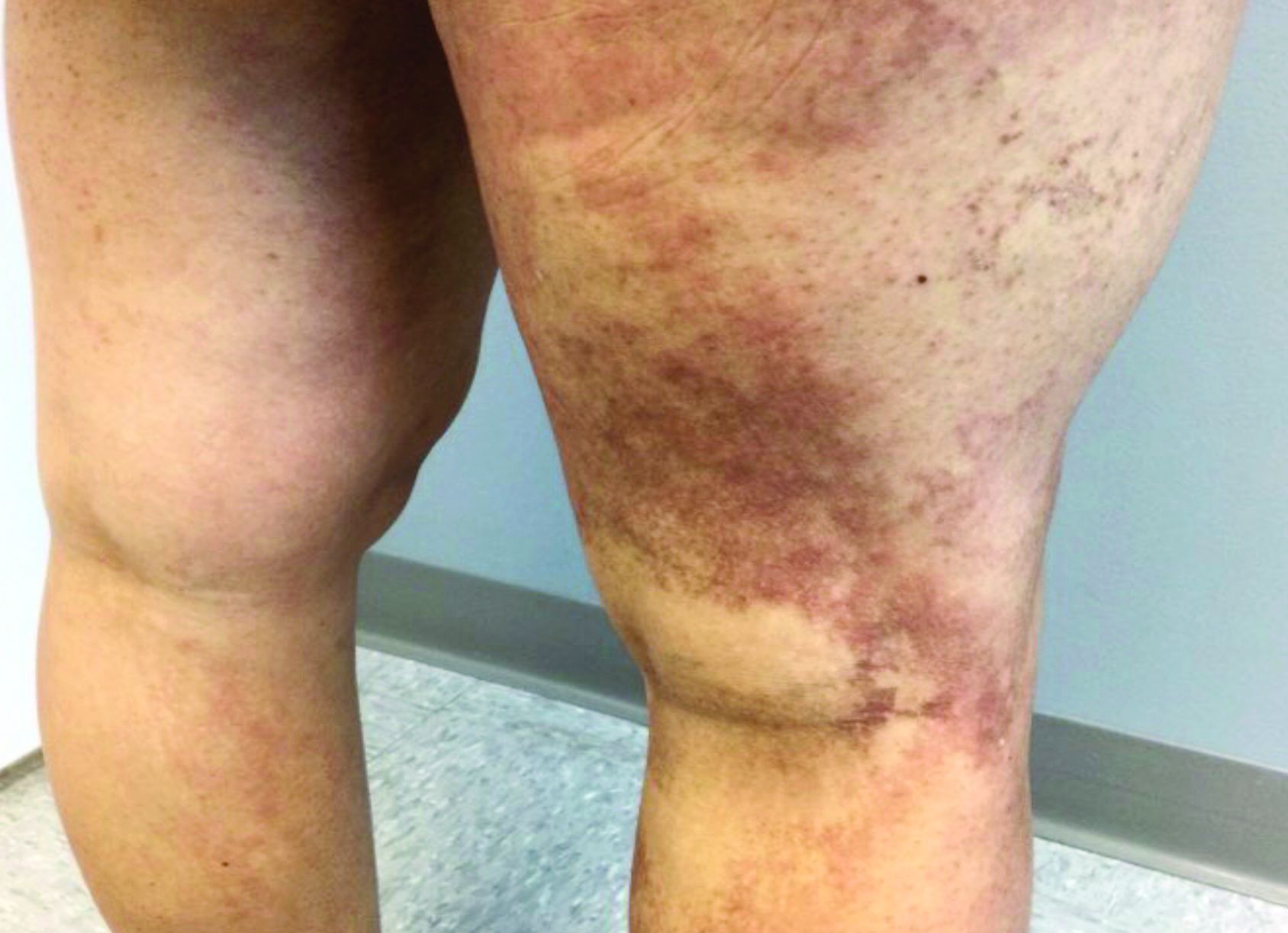 A 35 year old With Erythematous Dusky Patches On Both Lower