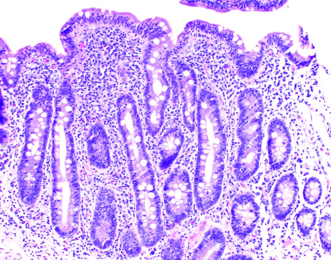 Hepatic presentations of celiac disease | GI and Hepatology News