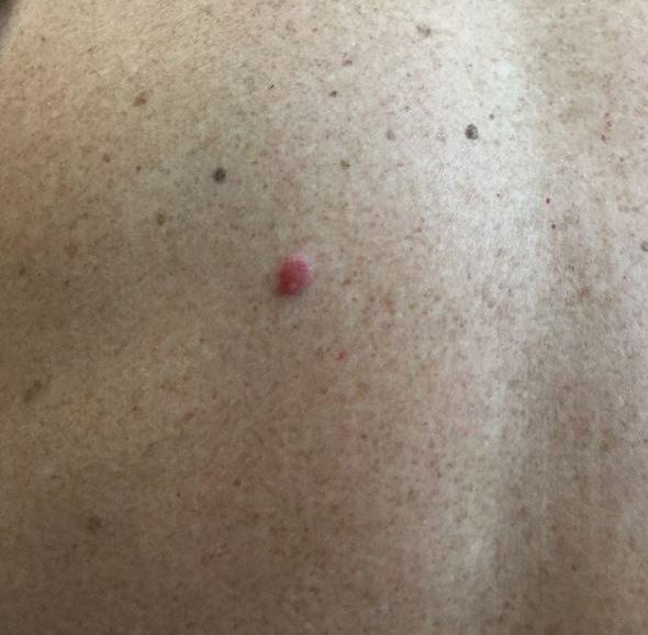Skin Nodule Treatment