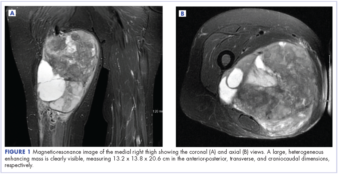 Management Of High grade Pleomorphic Sarcoma With Colon Metastasis Management Of High grade Pleomorphic Sarcoma With Colon Metastasis