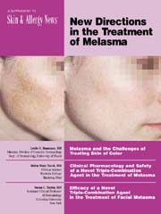 New Directions in the Treatment of Melasma | MDedge