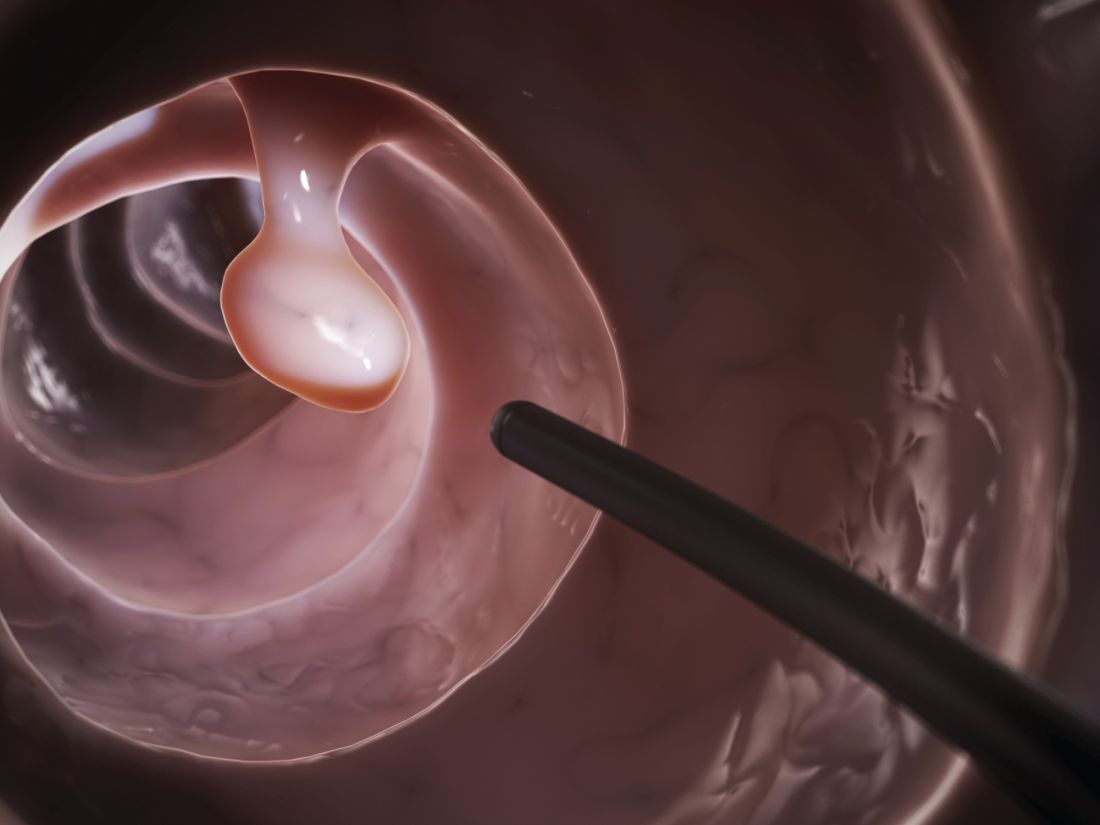 Colonoscopy Patients Prefer Propofol Over Fentanyl midazolam MDedge