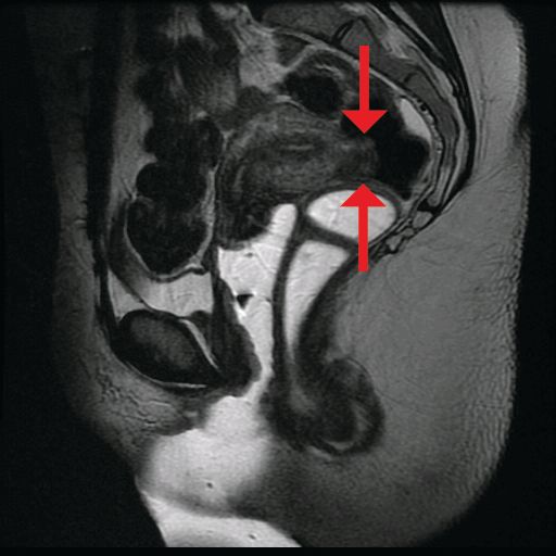 Anterior discoid resection using a ‘squeeze’ technique | MDedge