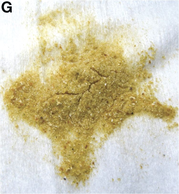 An Unusual Cause of Recurrent Severe Abdominal Colic | MDedge