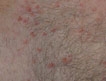 Chemotherapy-Induced Inflammatory Seborrheic Keratoses in a Man With ...