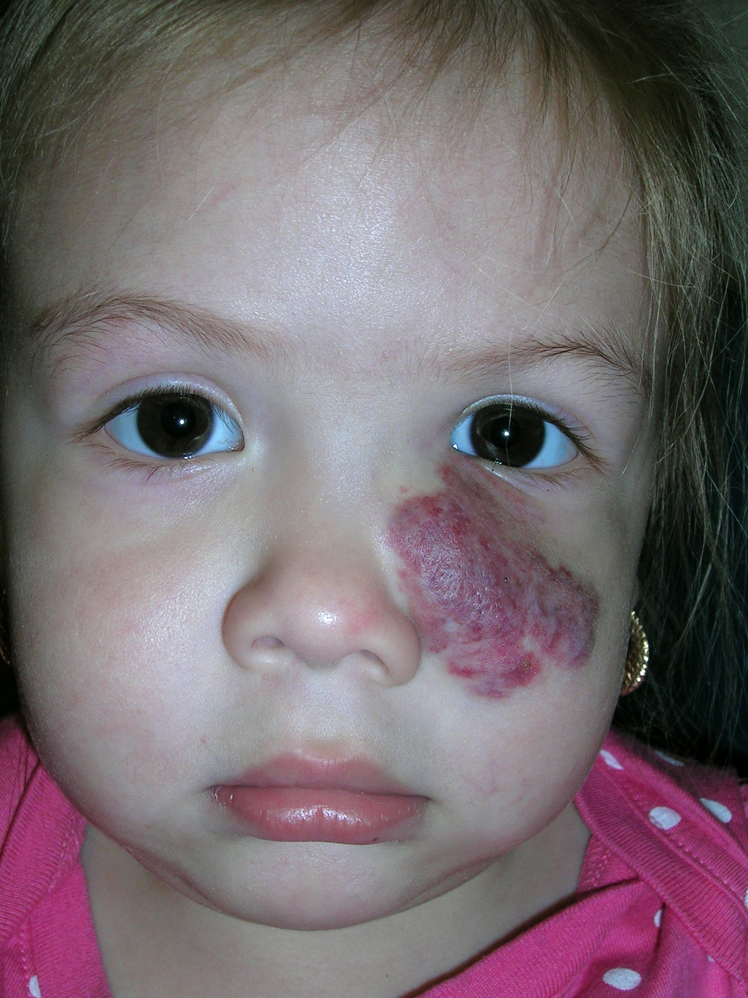Large Red Mass On Face MDedge Family Medicine