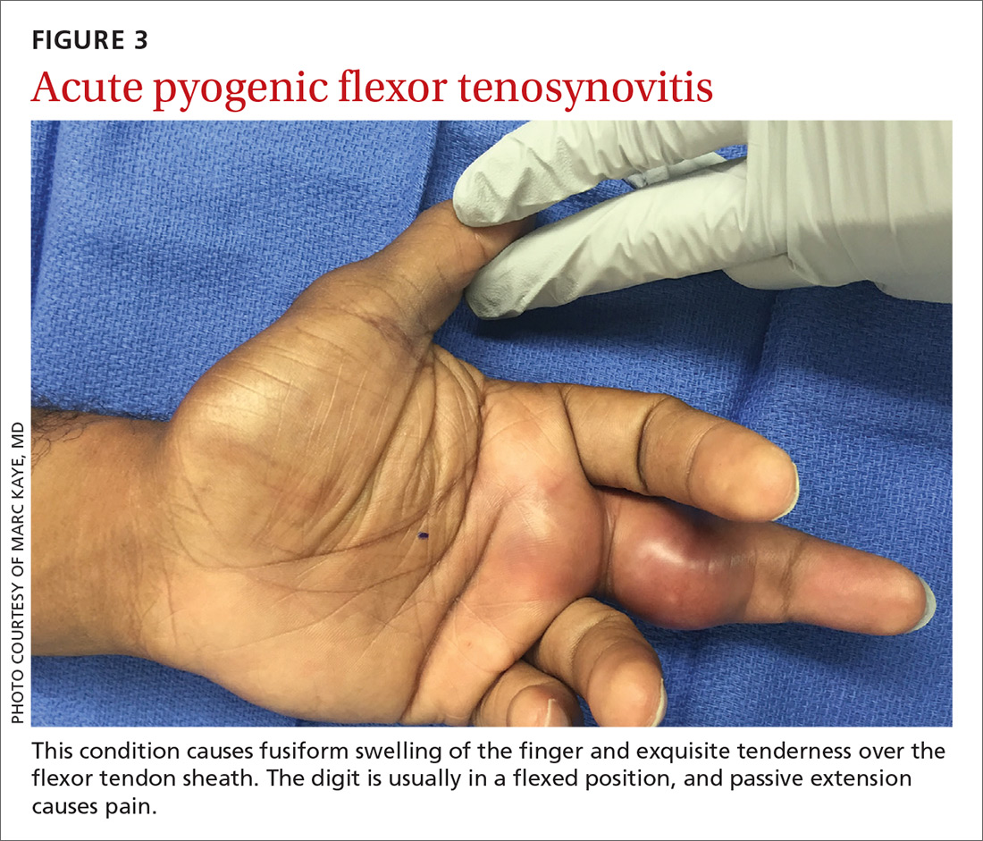 Abscess Finger Icd 10 At Alyssa Massy greene Blog
