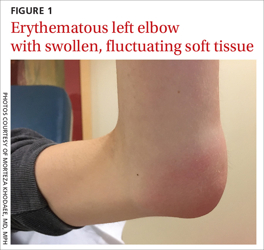 Painful Swollen Elbow MDedge