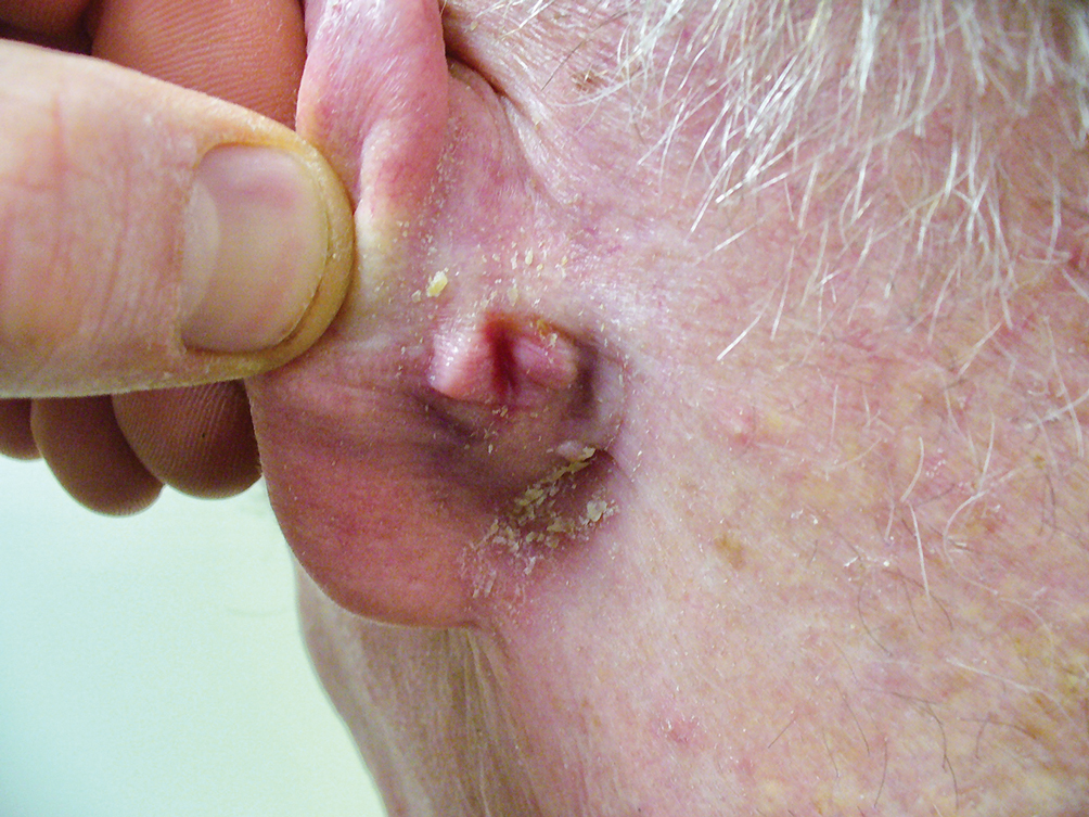 Pink Nodule Behind The Ear MDedge Dermatology Pink Nodule Behind The Ear MDedge Dermatology