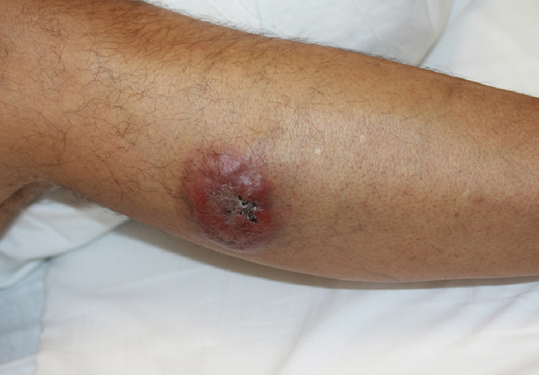 Painless Nodule On The Leg MDedge Dermatology