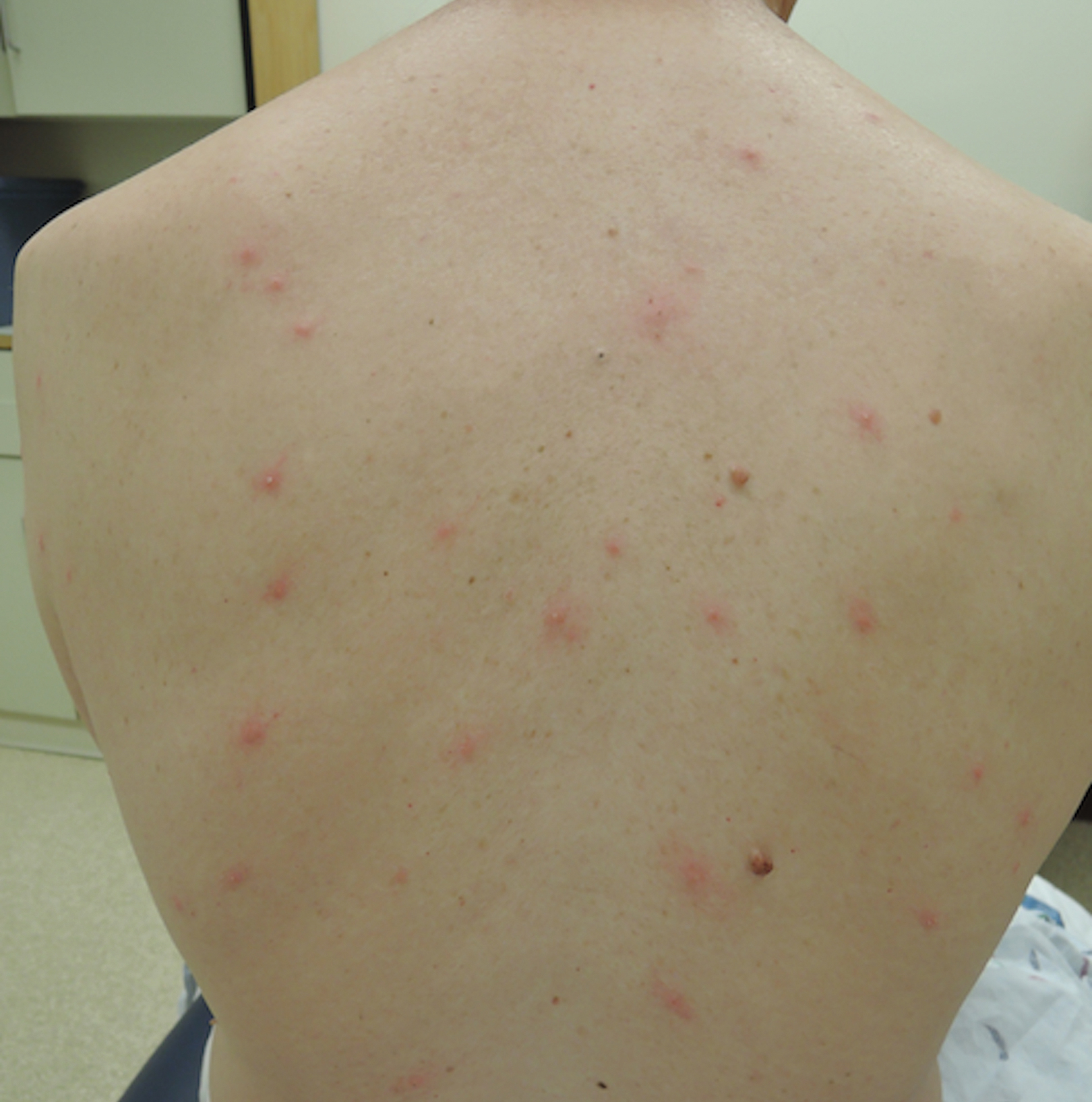 All 92 Images Tick Bite On Human Photos Stunning