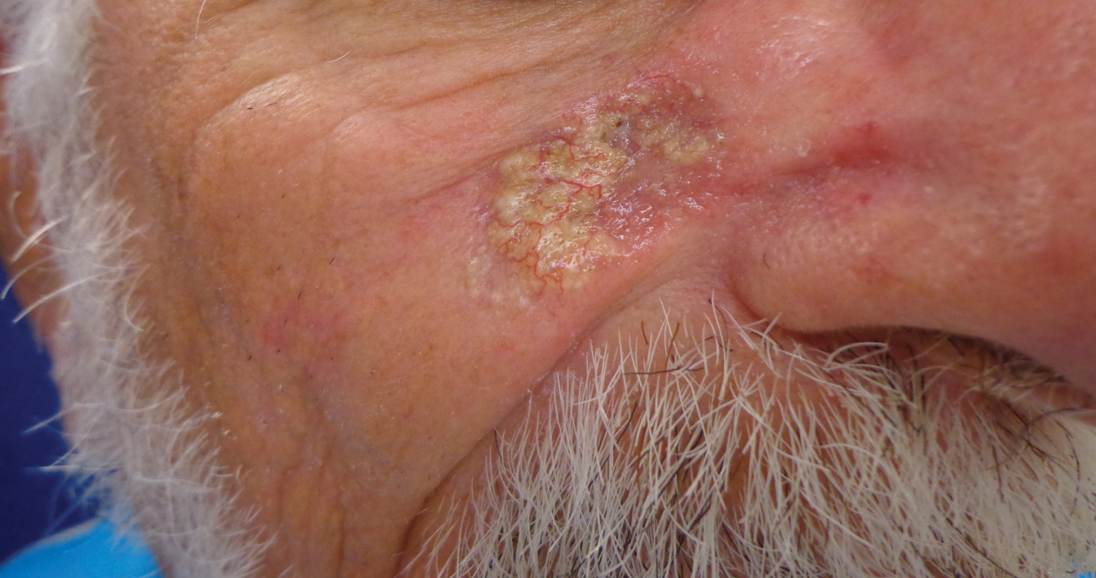  Va Disability Rating For Basal Cell Carcinoma Va Guard