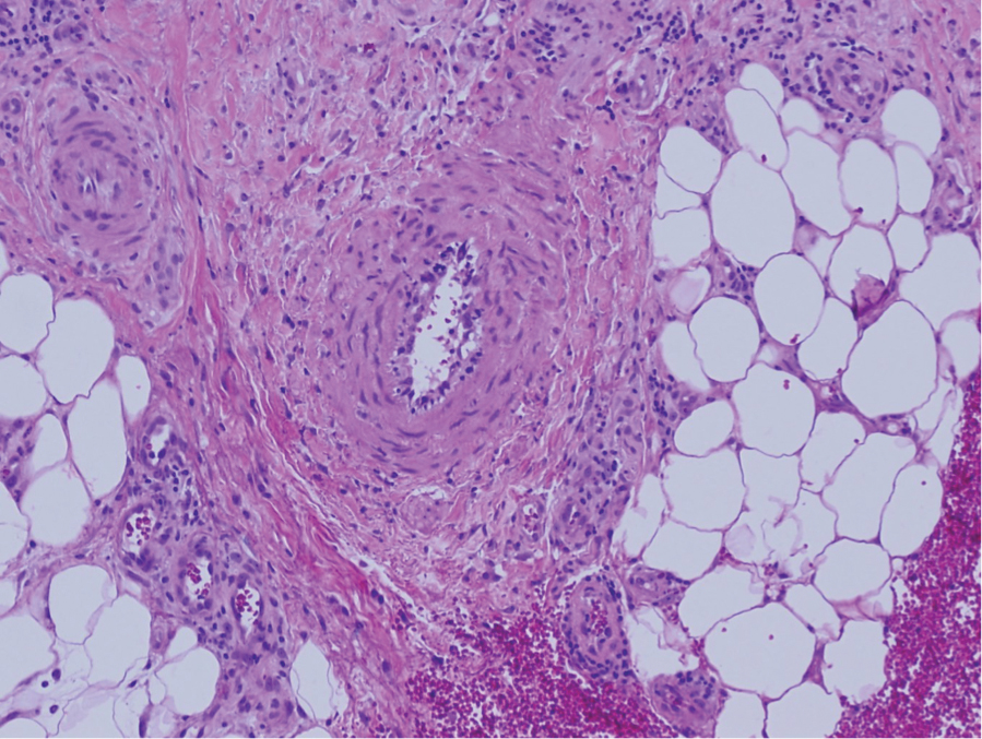Atrophic Lesions In A Pregnant Woman MDedge Dermatology