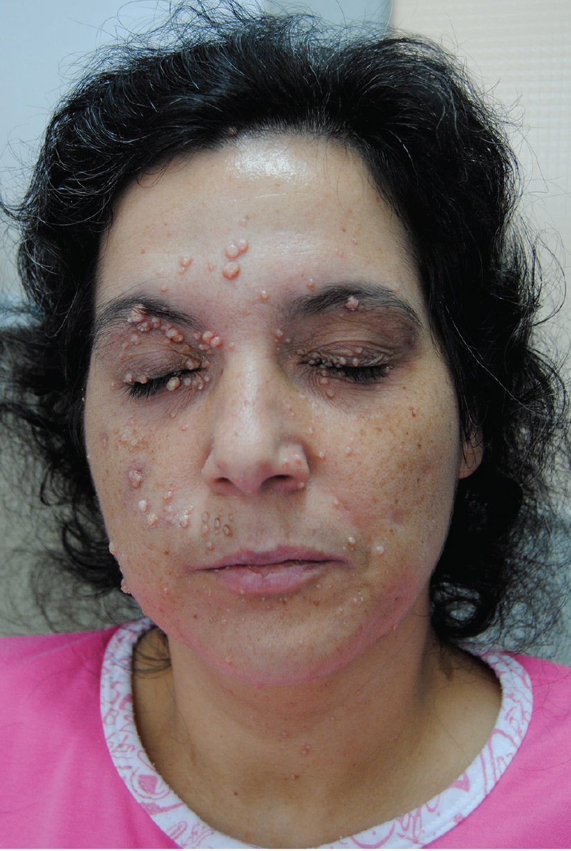 eruptive xanthomas face