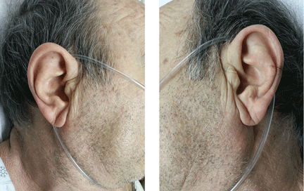 Bilateral earlobe creases and coronary artery disease | MDedge