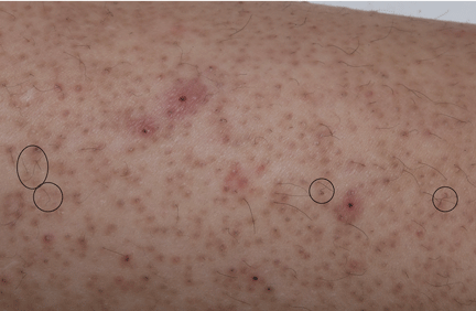 Corkscrew hairs | MDedge