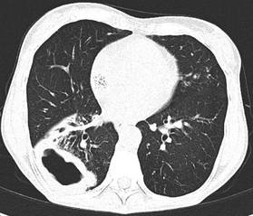 PULMONARY PERSPECTIVES®: Surgical treatment of pulmonary NTM infections ...