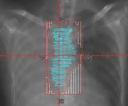 PULMONARY PERSPECTIVES®: Postoperative radiation therapy for non-small ...