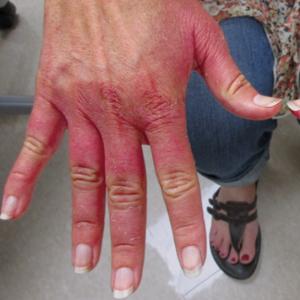 Erythematous Edematous Plaques on the Dorsal Aspects of the Hands | MDedge