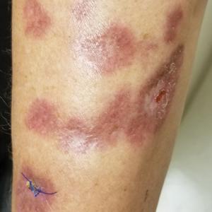 Annular Atrophic Plaques on the Forearm | MDedge