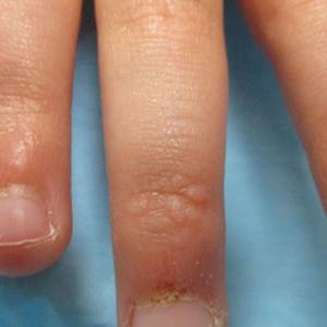 Papules and Telangiectases on the Distal Fingers of a Child | MDedge
