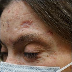 Multiple basal cell carcinomas | MDedge