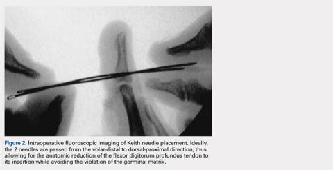 A Novel Technique for the Treatment of Jersey Fingers | MDedge Surgery