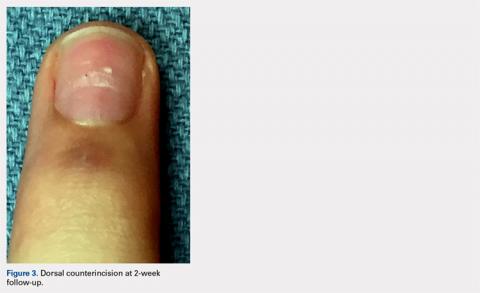 A Novel Technique for the Treatment of Jersey Fingers | MDedge Surgery