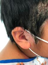 A 9-year-old male presents with multiple thick scaly plaques on scalp ...