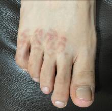 Nonblanching, Erythematous, Cerebriform Plaques on the Foot | MDedge