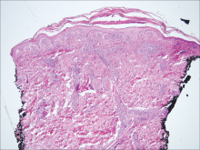 Disseminated Vesicles and Necrotic Papules | MDedge