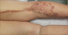 Linear Porokeratosis Associated With Multiple Squamous Cell Carcinomas ...