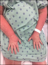 DRESS Syndrome: Clinical Myths and Pearls | MDedge