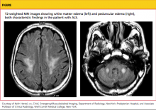 Amyotrophic Lateral Sclerosis: Diagnosis and Appropriate Management ...