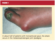 Gout: A Clinical Overview | Clinician Reviews