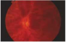 Sudden loss of vision | MDedge Family Medicine