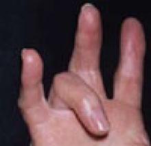 Are steroid injections effective for tenosynovitis of the hand ...