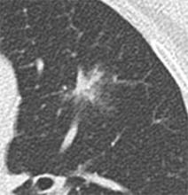 PULMONARY PERSPECTIVES®: Subsolid nodules – Significance and CT | MDedge