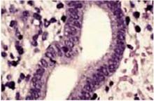 Conservative management of endometrial hyperplasia: New strategies and ...