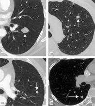 NCCN Affirms CT Scans For Heavy Smokers | MDedge