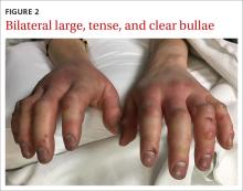 Acute bilateral hand edema and vesiculation | MDedge