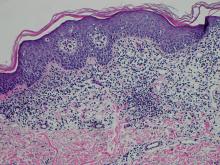 Annular Erythematous Plaques on the Back | MDedge