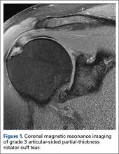 High-Grade Articular, Bursal, and Intratendinous Partial-Thickness ...