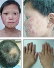 A Case of Bloom Syndrome With Uncommon Clinical Manifestations ...