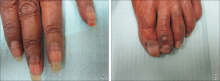 Transverse Melanonychia and Palmar Hyperpigmentation Secondary to ...