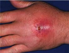 What is the best empiric therapy for community-acquired cellulitis ...