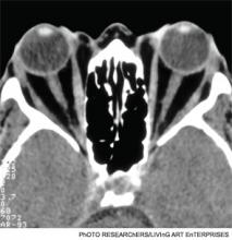 How is Graves' Disease Diagnosed and Evaluated? | The Hospitalist