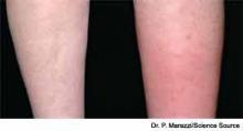 What Is the Best Empiric Therapy for Community-Acquired Cellulitis ...