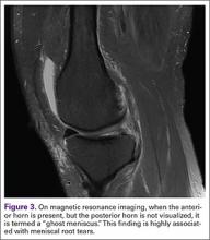 Meniscal Root Tears: Identification and Repair | MDedge Surgery