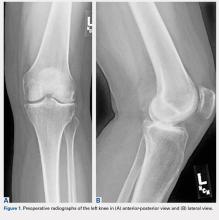 Mycobacterium abscessus: A Rare Cause of Periprosthetic Knee Joint ...